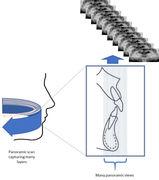 Why Won’t My Panoramic X-Rays Show the Anterior Apices?