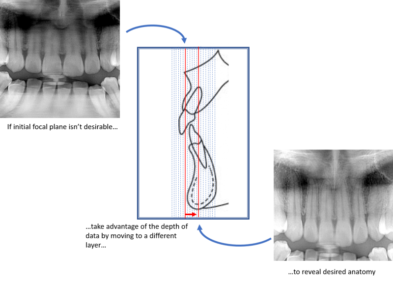 Why Won’t My Panoramic X-Rays Show the Anterior Apices?