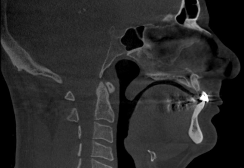Assessment of Obstructive Sleep Apnea Using a Dental Cone Beam