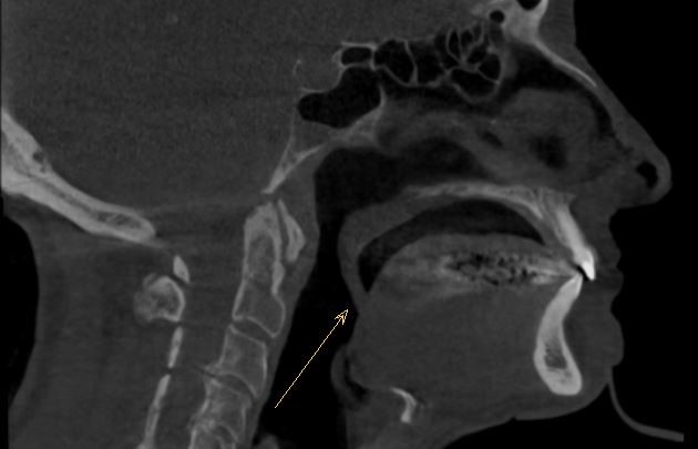 Assessment of Obstructive Sleep Apnea Using a Dental Cone Beam