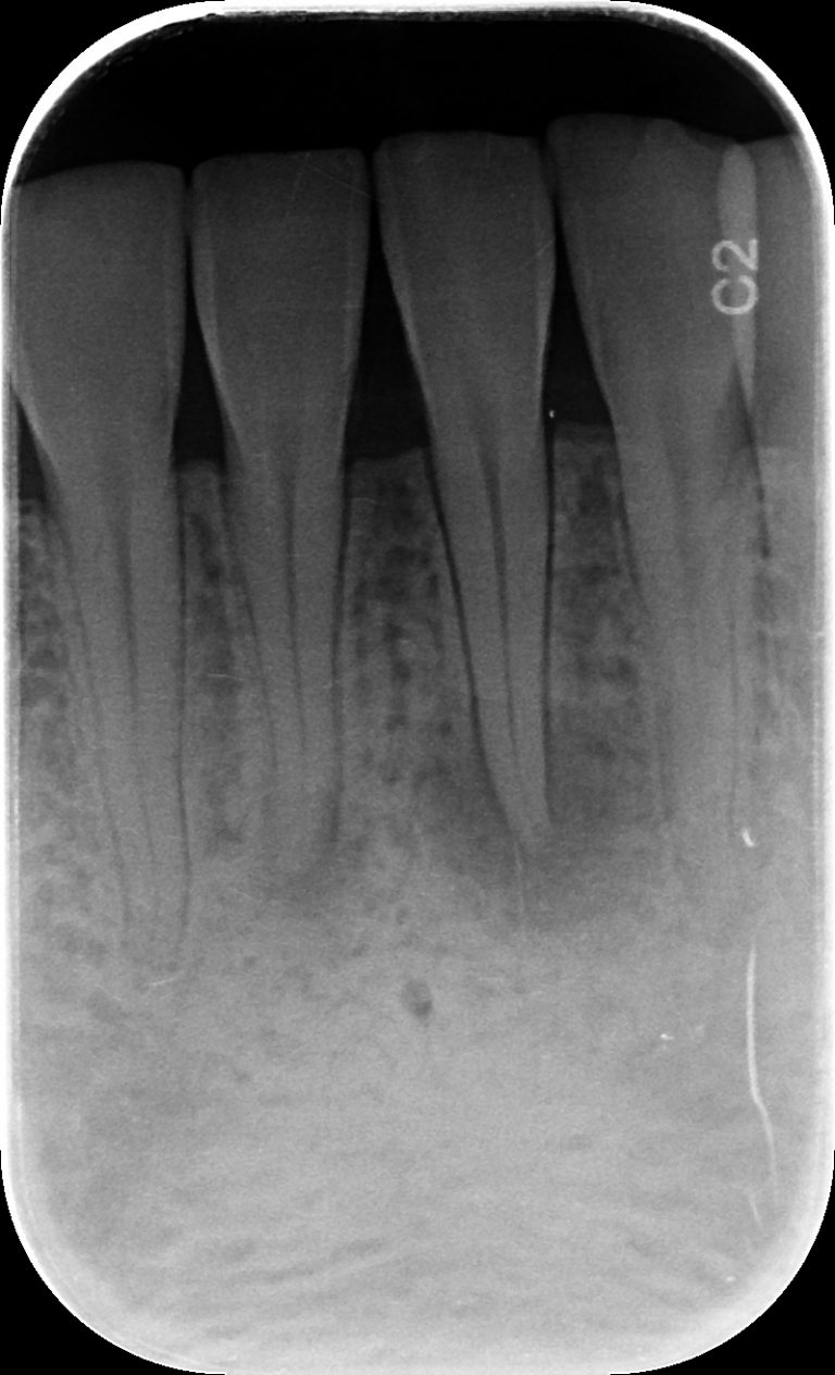 Case Study: Abscess on #24